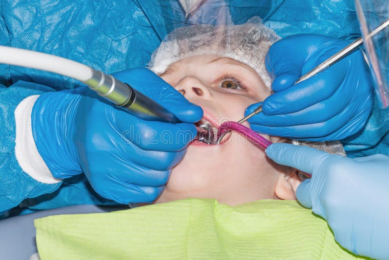 The Process of Treating a Sick Tooth in a Child Stock Image - Image of ...