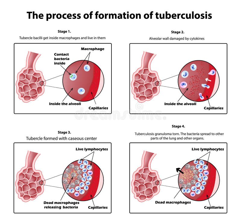 The Process of Tuberculosis Formation. Infographics. Vector ...