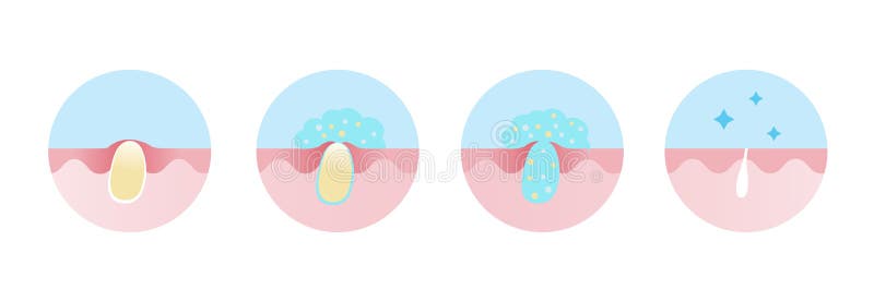 Process of Whitehead Acne Pimple Treatment Vector Icon Set Illustration ...