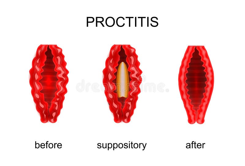 Proctitis Prima E Dopo Il Trattamento Delle Supposte Rettali ...