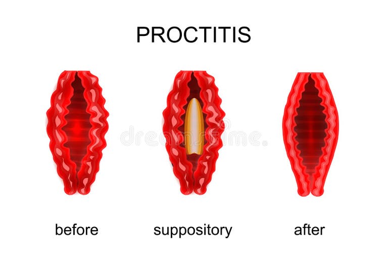 Proctitis. before and after Treatment of Rectal Suppositories Stock ...