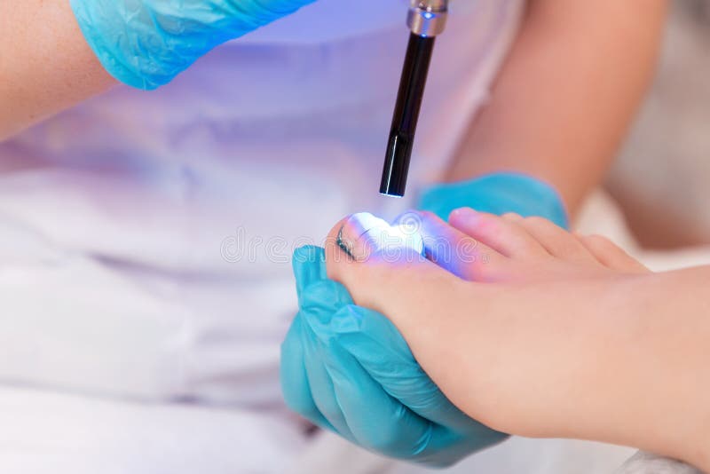 Professional Pedicure. Podologist Installs a Titanium Thread on the Big ...