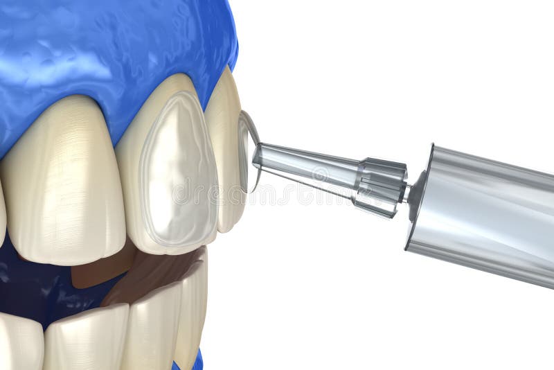 Professional Teeth Whitening. Adding Gel Over Teeth Stock Illustration ...