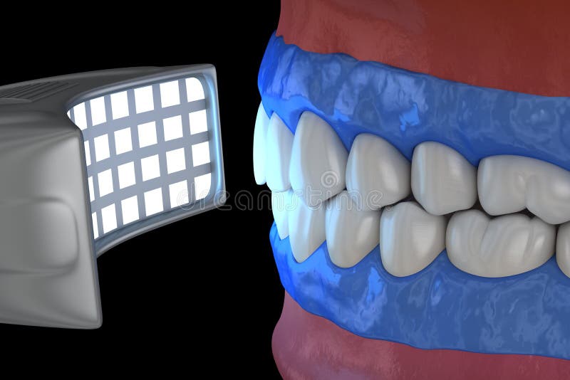 Professional Teeth Whitening. Gel Activation Lamp Stock Illustration ...