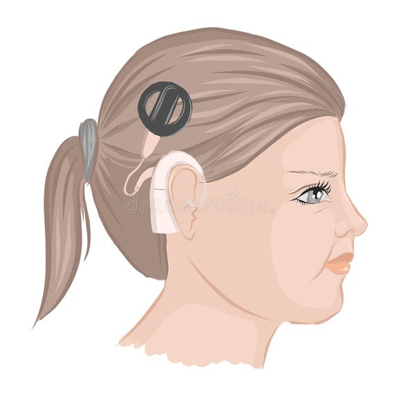 Profile of a Girl with a Cochlear Device on Her Ear. Stock Vector ...