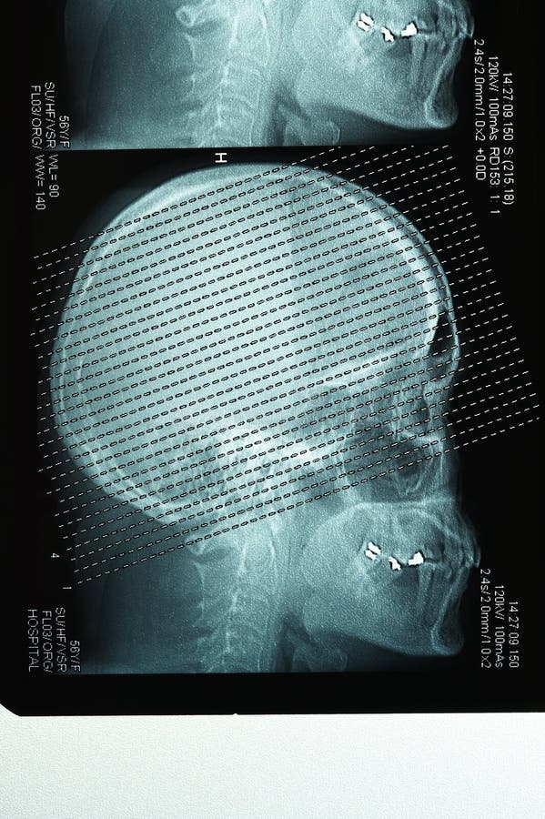Profile View with a Human Skull X Ray Stock Photo - Image of ...