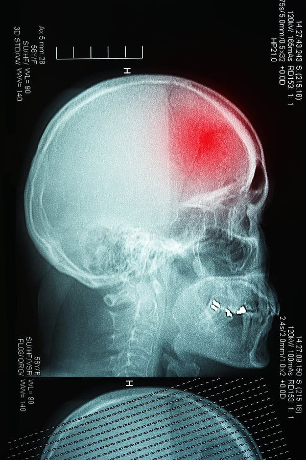 Profile View with a Human Skull X Ray Stock Image - Image of medical ...