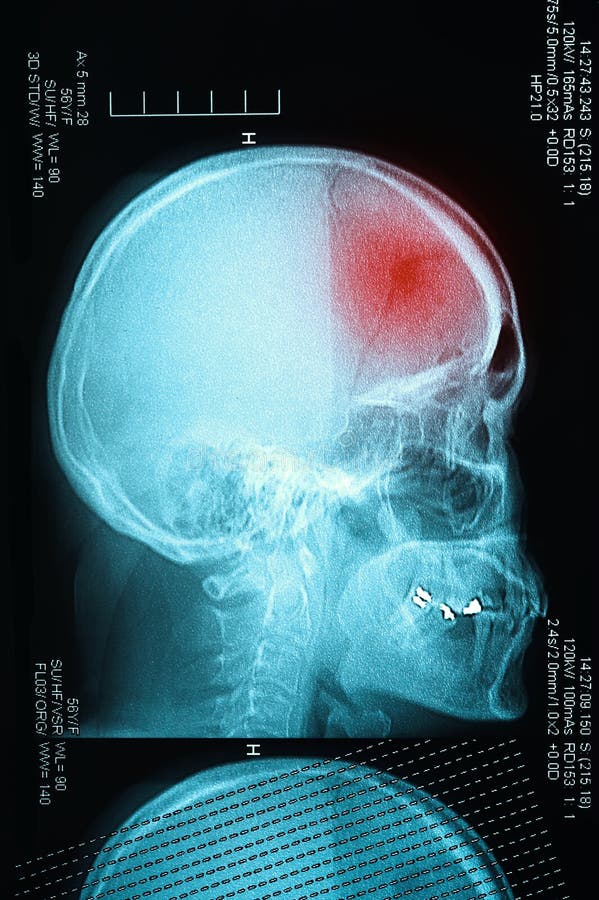 Profile View with a Human Skull X Ray Stock Image - Image of ...