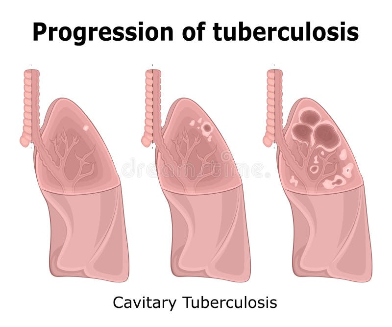 Ejemplo De La Tuberculosis Pulmonar Ilustración del Vector ...
