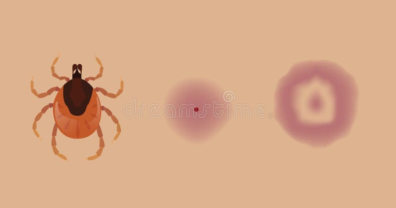 Tick Biting Skin Causing Disease and Erythema Migrans Rash Stock Vector ...