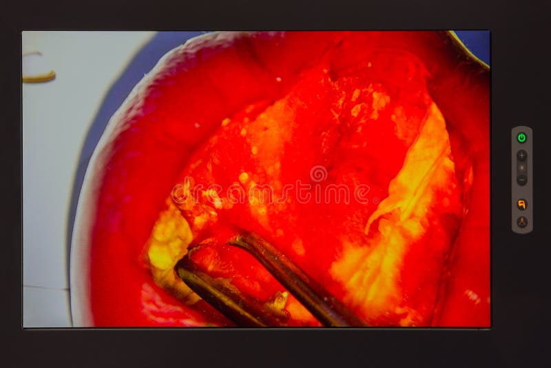 Projection on the Screen during Surgery Stock Photo - Image of hospital ...