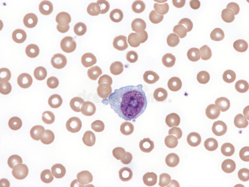 Prolymphocyte in Peripheral Blood. Stock Photo - Image of leukemia ...