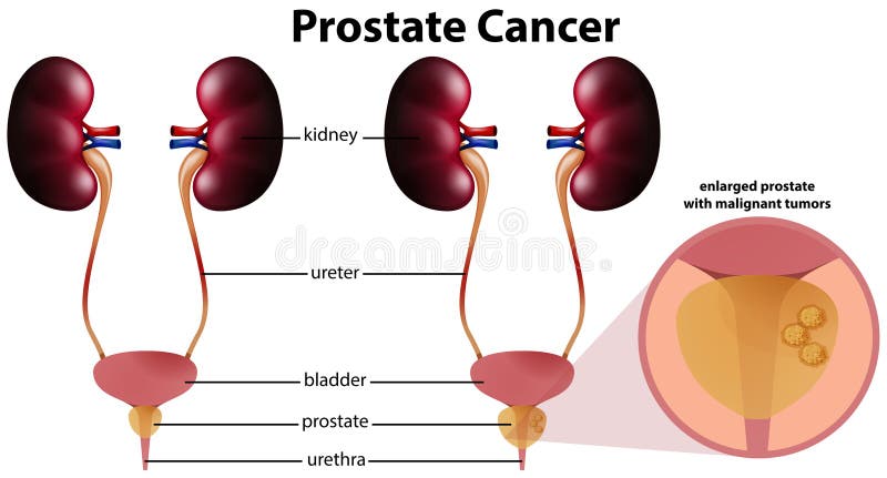 Prostatacancer Stock Illustrationer, Vektorer, & Clipart – (961 Stock ...