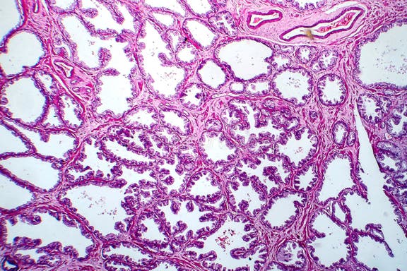 Prostate Cancer, Light Micrograph Stock Photo - Image of ...