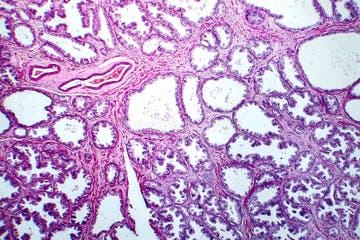 Prostate Cancer, Light Micrograph Stock Image - Image of neoplasm ...