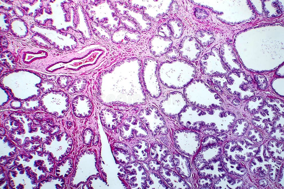 Prostate Cancer, Light Micrograph Stock Image - Image of neoplasm ...