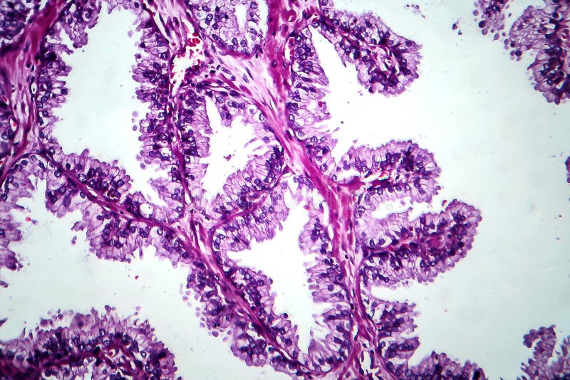 Prostate Cancer, Light Micrograph Stock Image - Image of histopathology ...