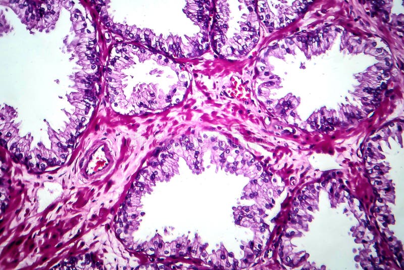 Prostate Cancer, Light Micrograph Stock Image - Image of neoplasm ...