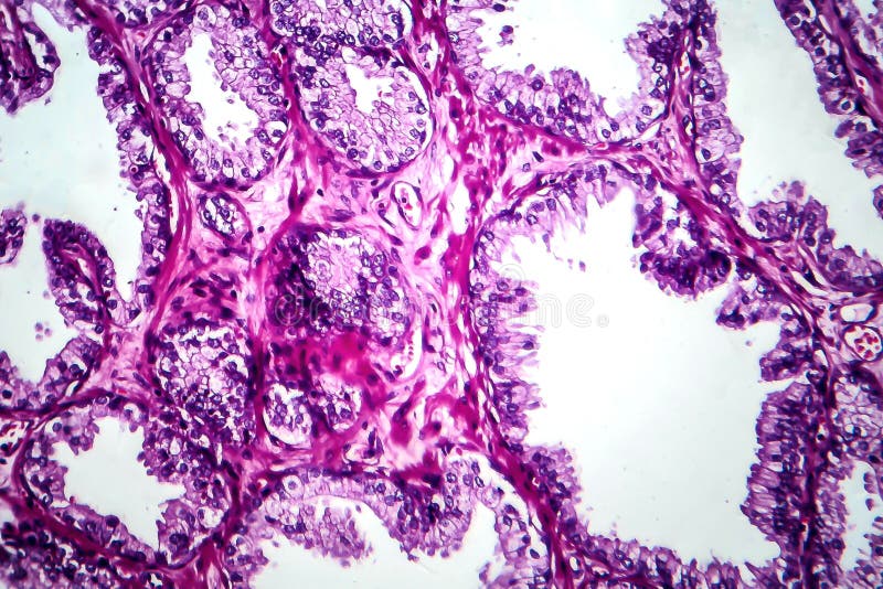 Prostate Cancer, Light Micrograph Stock Image - Image of cancer ...