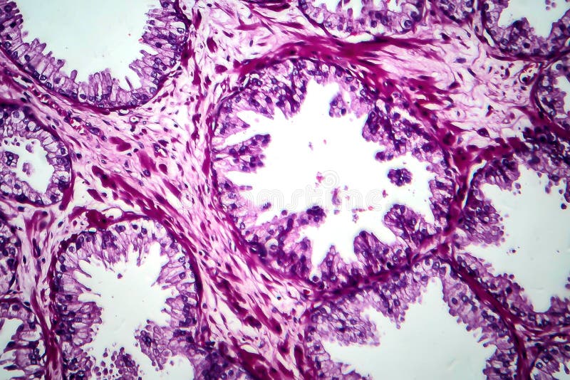 Prostate Cancer, Light Micrograph Stock Image - Image of illness ...
