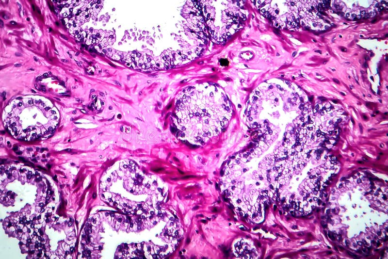 Prostate Cancer, Light Micrograph Stock Image - Image of illness ...