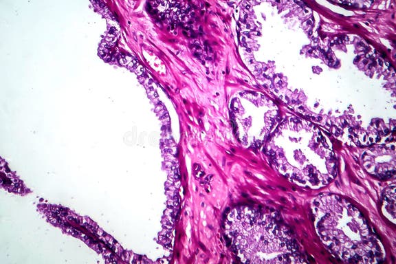 Prostate Cancer, Light Micrograph Stock Photo - Image of gland, eosin ...
