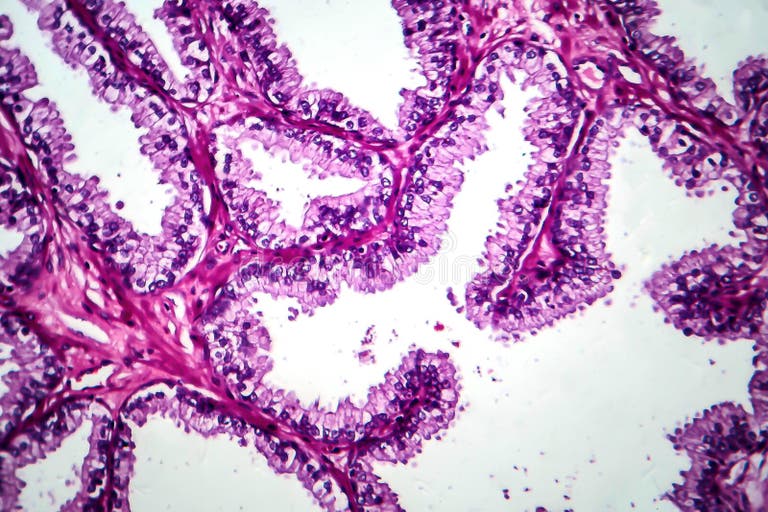 Prostate Cancer, Light Micrograph Stock Image - Image of microscopy ...