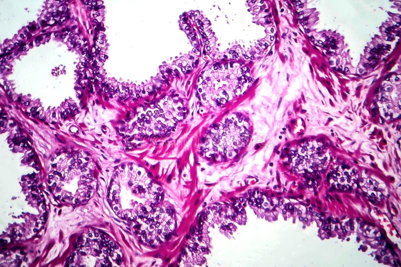 Prostate Cancer, Light Micrograph Stock Photo - Image of oncology ...