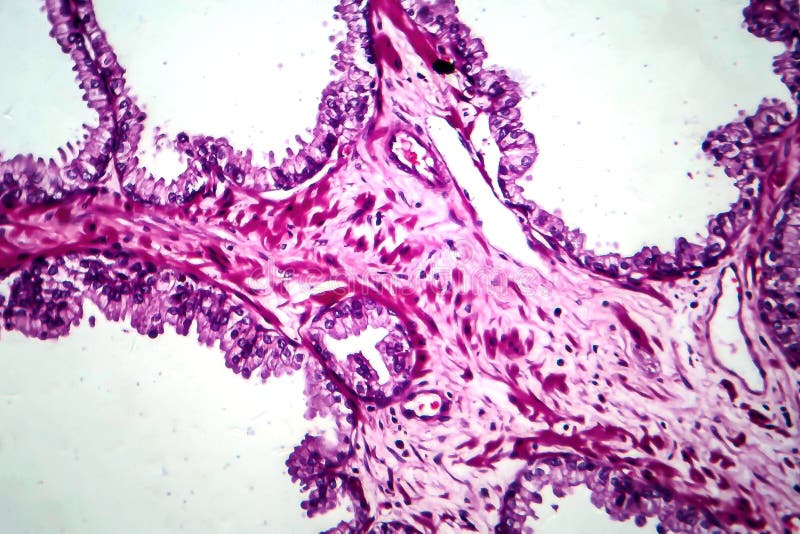 Prostate Cancer, Light Micrograph Stock Photo - Image of histopathology ...