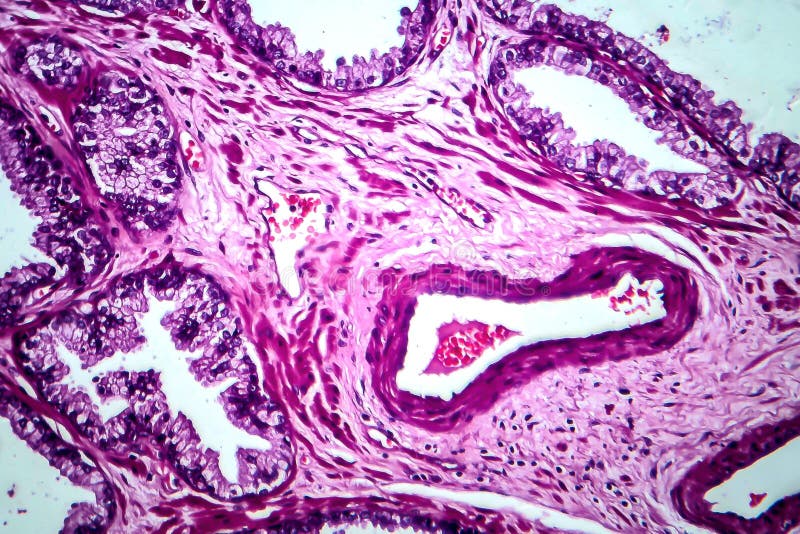 Prostate Cancer, Light Micrograph Stock Image - Image of medical ...