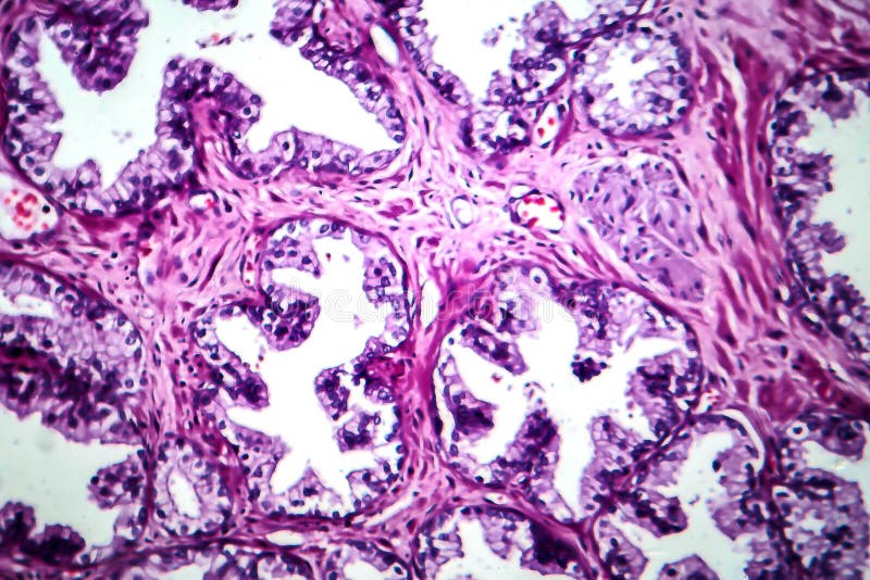 Prostate Cancer, Light Micrograph Stock Photo - Image of tissue ...