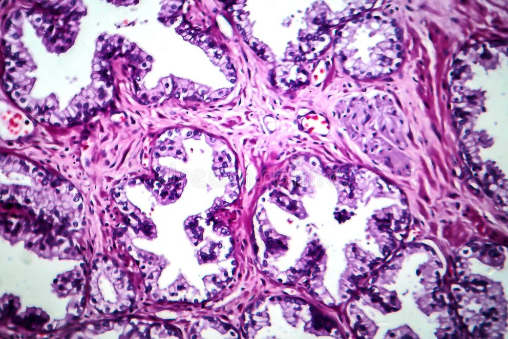 Prostate Cancer, Light Micrograph Stock Photo - Image of tissue ...