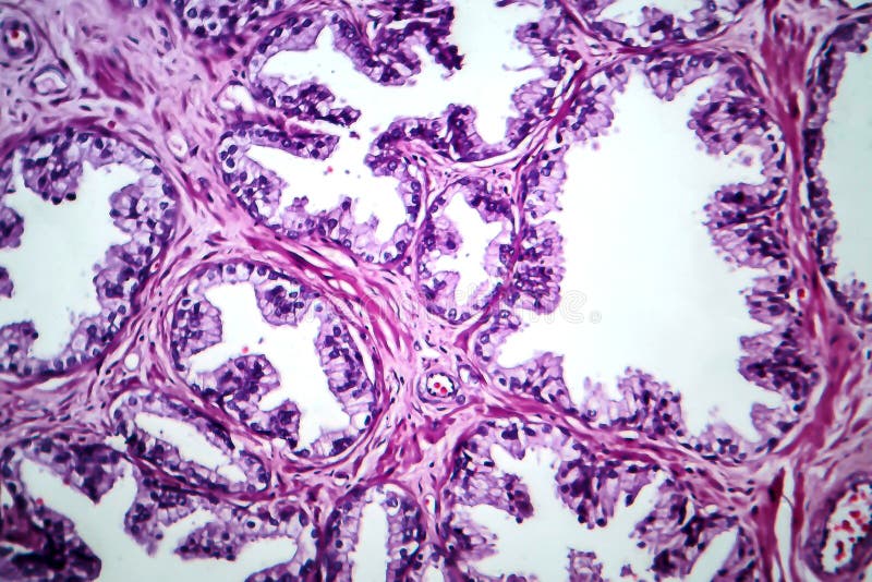 Prostate Cancer, Light Micrograph Stock Photo - Image of micrograph ...