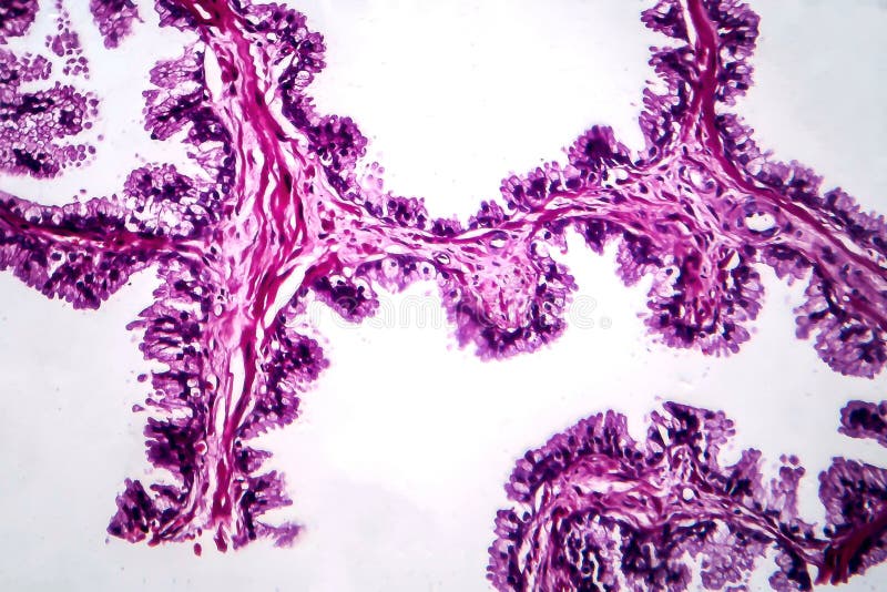 Prostate Cancer, Light Micrograph Stock Image - Image of microscopy ...