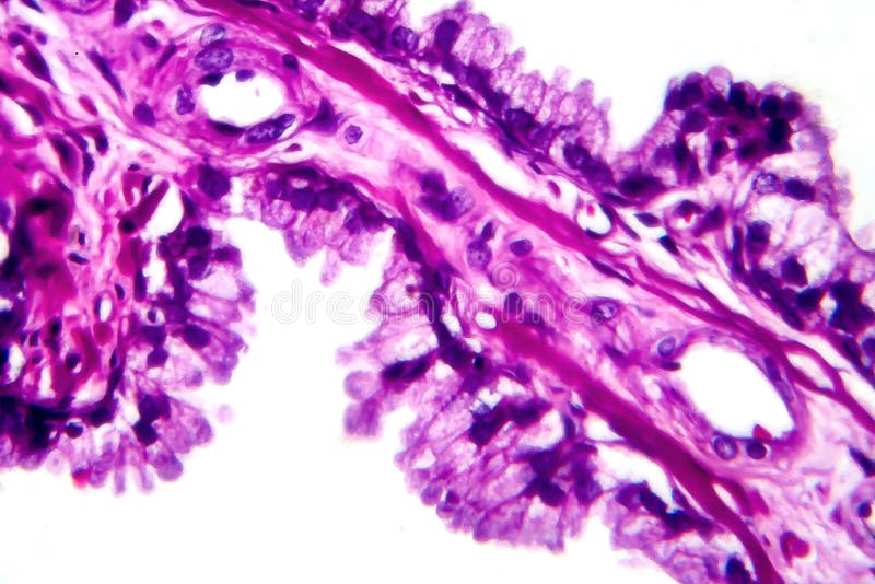 Prostate Cancer, Light Micrograph Stock Image - Image of microscopic ...