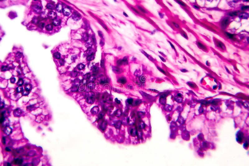 Prostate Cancer, Light Micrograph Stock Photo - Image of prostate ...