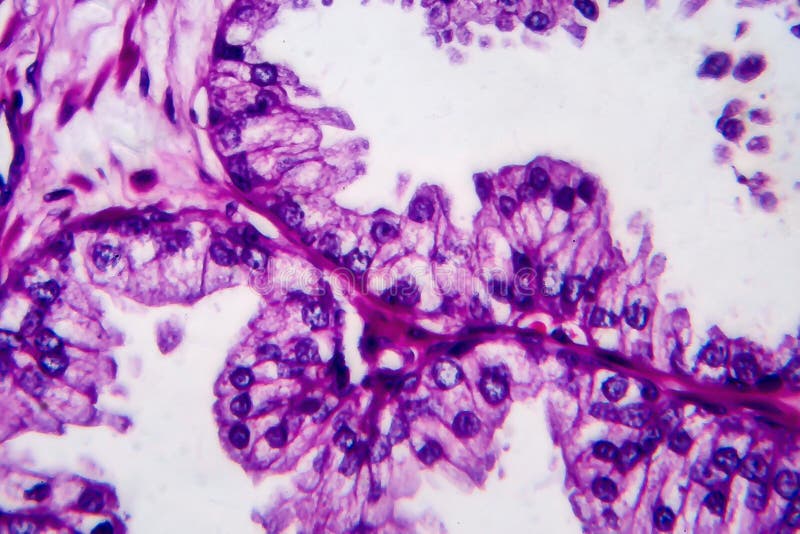 Prostate Cancer, Light Micrograph Stock Photo - Image of disease ...