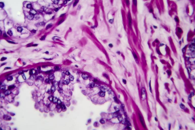 Prostate Cancer, Light Micrograph Stock Image - Image of morphological ...
