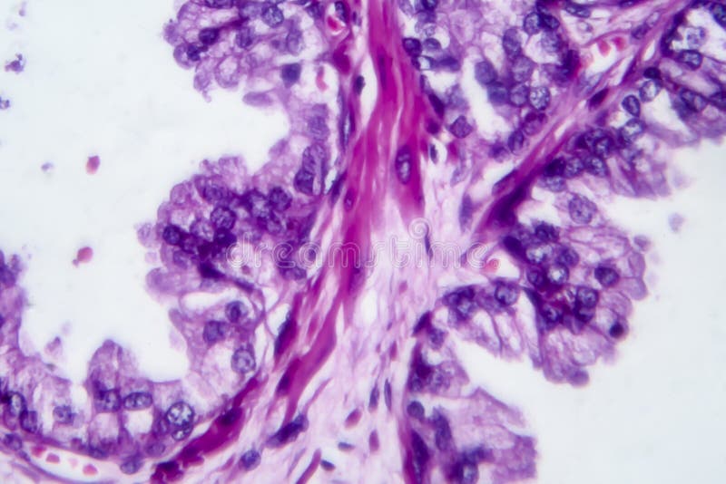 Prostate Cancer, Light Micrograph Stock Image - Image of neoplasm ...