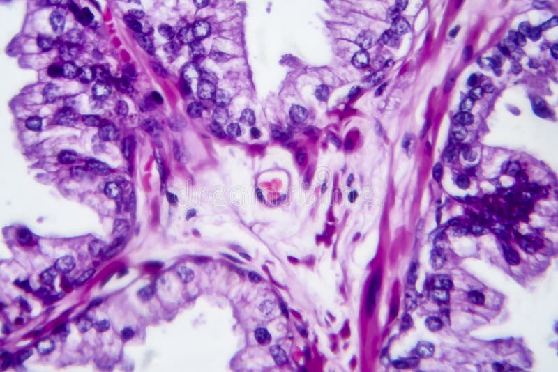 Prostate Cancer, Light Micrograph Stock Photo - Image of morphology ...