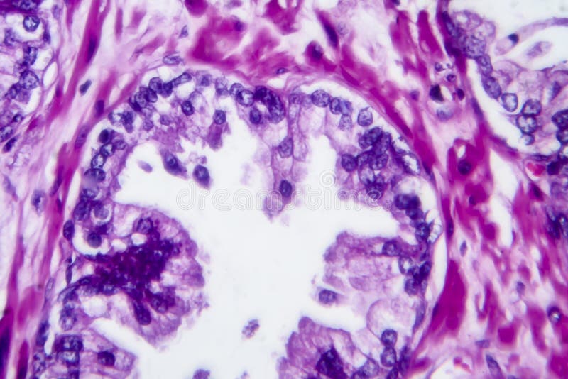 Prostate Cancer, Light Micrograph Stock Photo - Image of eosin ...