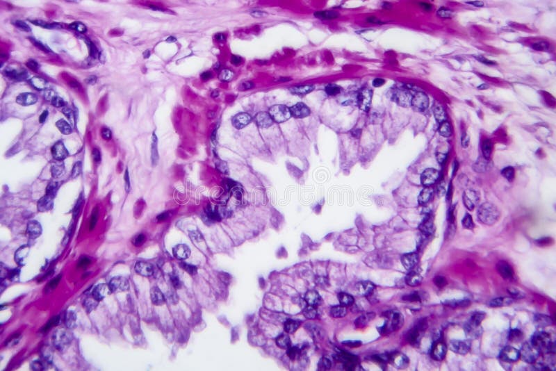Prostate Cancer, Light Micrograph Stock Photo - Image of pathology ...