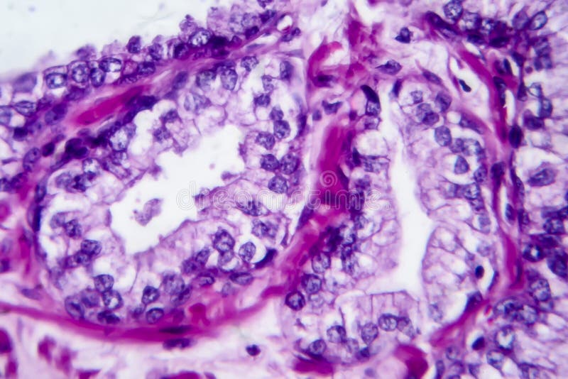 Prostate Cancer, Light Micrograph Stock Image - Image of hematoxylin ...