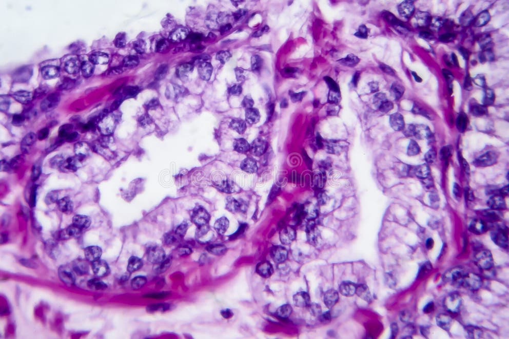 Prostate Cancer, Light Micrograph Stock Image - Image of hematoxylin ...