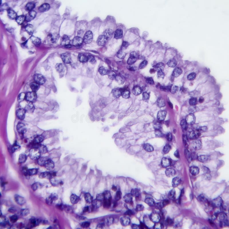 Prostate Cancer, Light Micrograph Stock Photo - Image of tissue ...