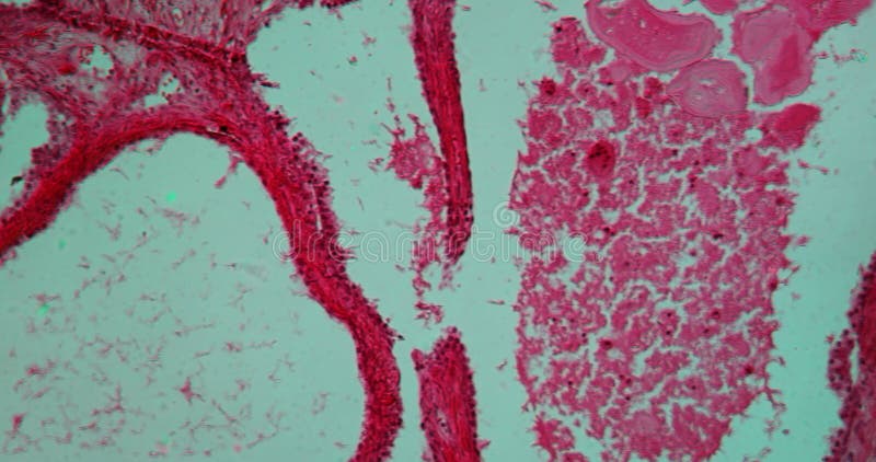 Prostate Enlarging Diseased Tissue Stock Footage - Video of microscopy ...