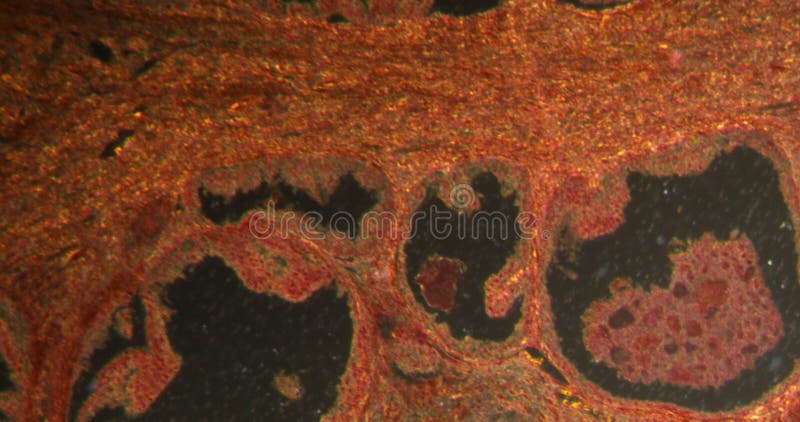 Prostate Hypertrophy in Darkfield Stock Footage - Video of blue, cells ...