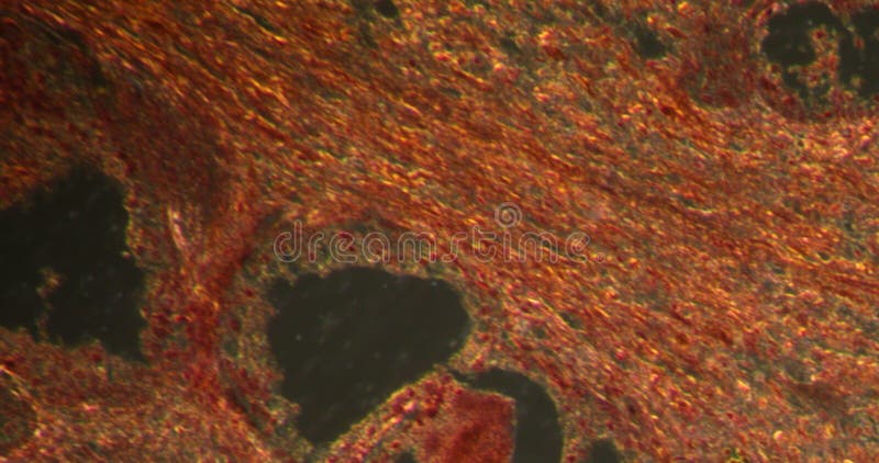 Prostate Hypertrophy in Darkfield Stock Video - Video of digestion ...