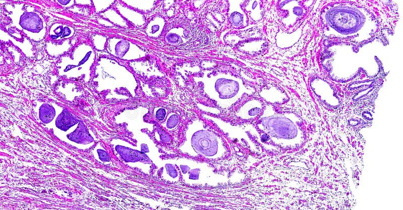 Prostate Hypertrophy of a Human Stock Image - Image of macro, human ...