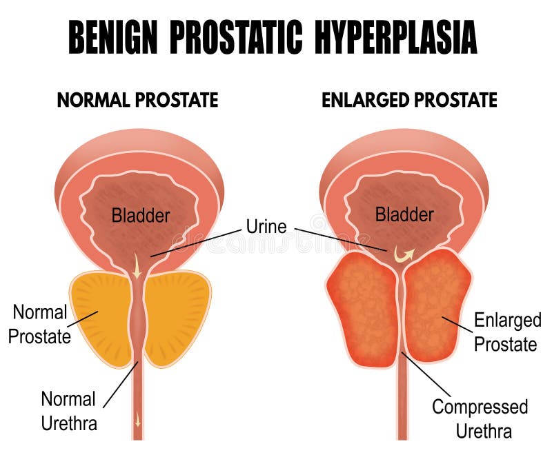 Prostatic Godartad Hyperplasia Vektor Illustrationer - Illustration av ...